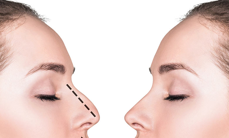 پلاسما جت بینی چیست؟ پلاسما جت بینی گوشتی [بررسی ماندگاری]