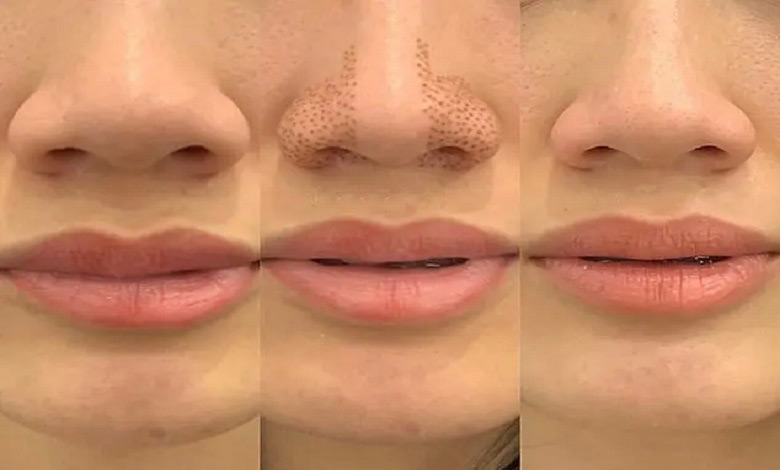 پلاسما جت بینی چیست؟ پلاسما جت بینی گوشتی [بررسی ماندگاری]